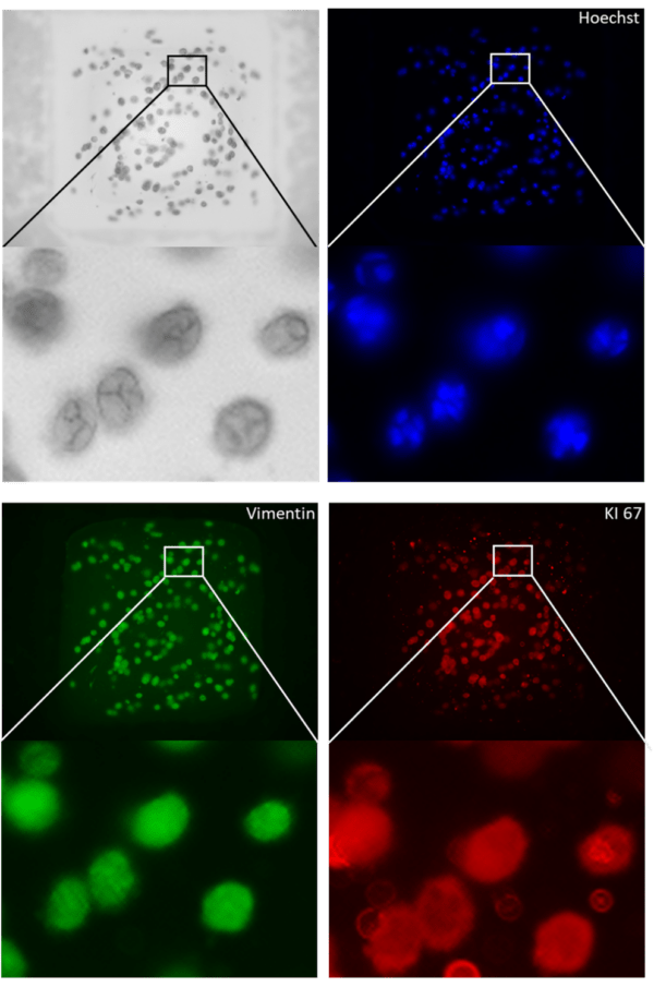 Generation of Tumor Cell Spheroids in Miniaturized Nanoliter Droplets ...