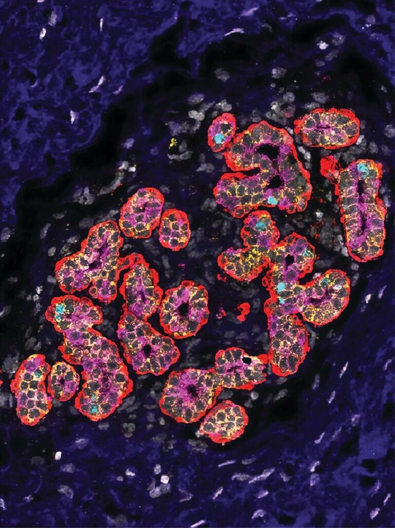 Multiple Ways to Study Breast Cancer Models with VitroGel®